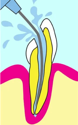 Root Canal | Gangi Dental Care